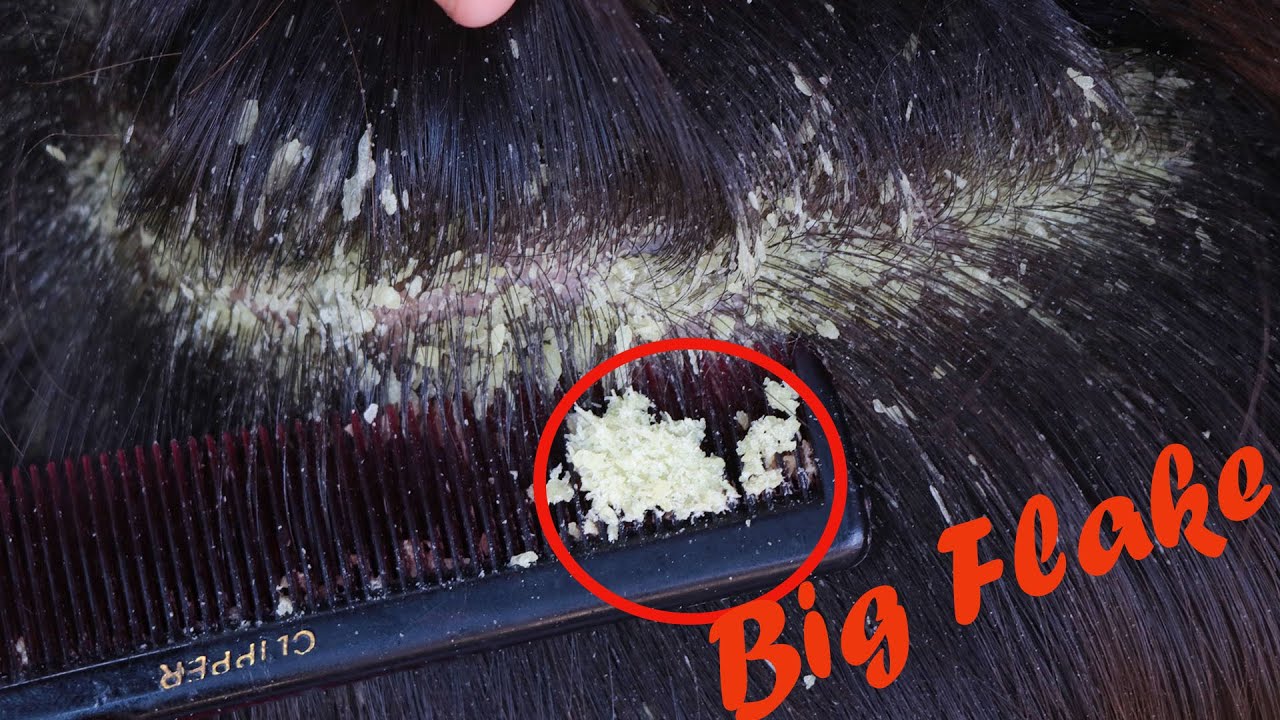 Itchy Scalp Removal | Dandruff Scratching Big Flakes #524 - YouTube