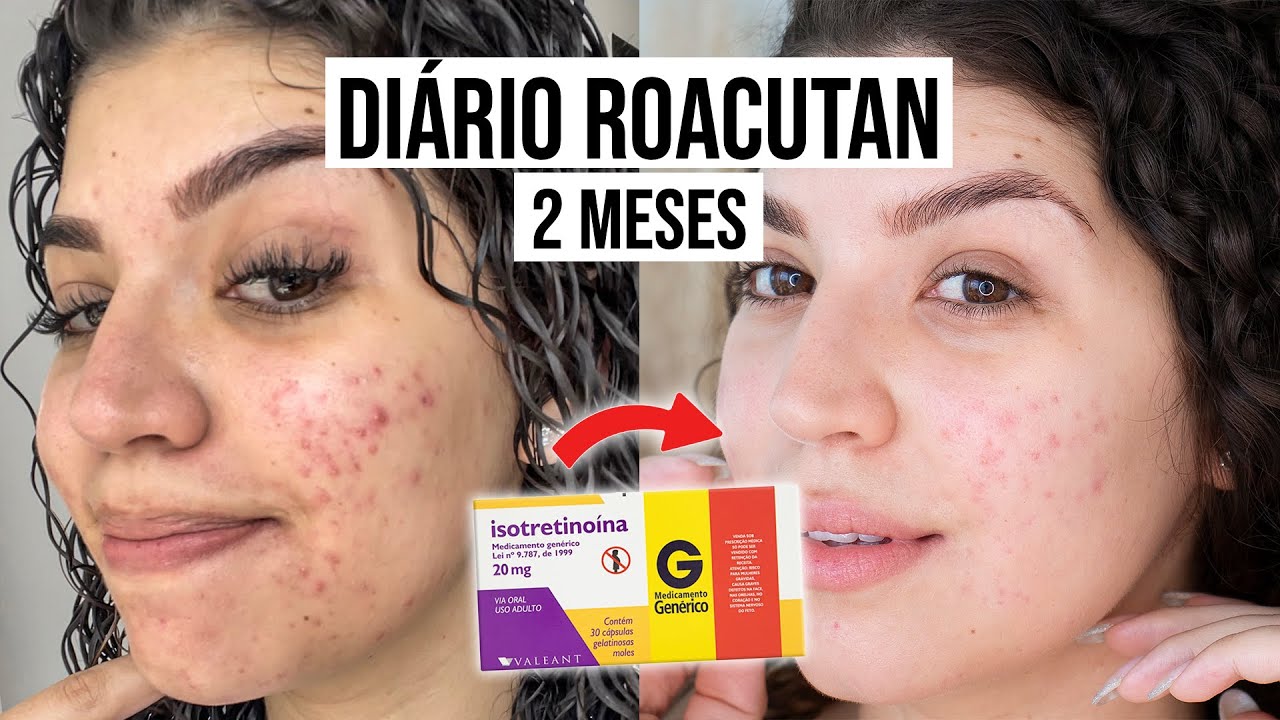 2 MESES COM ROACUTAN - Efeitos colaterais, produtos que tô usando e ...