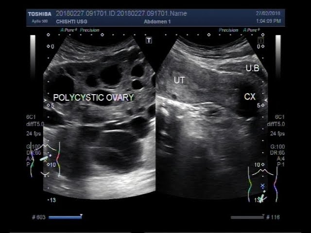 Normal Vs Polycystic Ovaries Ultrasound