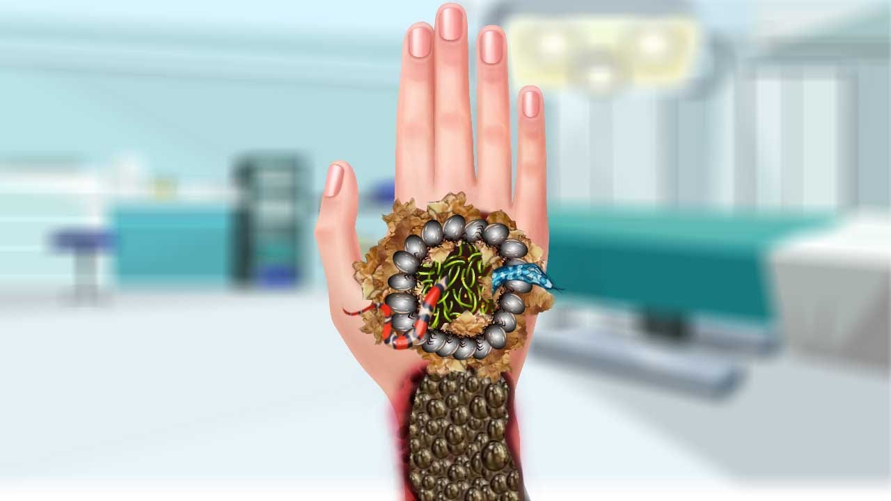 ASMR Treatment Dog tick removal, Maggot & Snake from Infected girl Hand ...