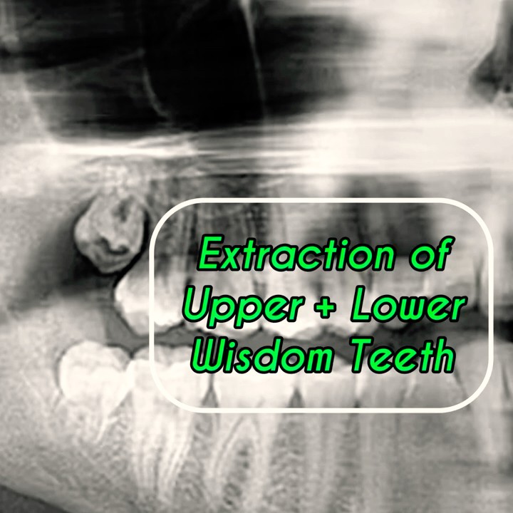 Upper and Lower Wisdom Teeth Extractions with Dr. Wahan - YouTube