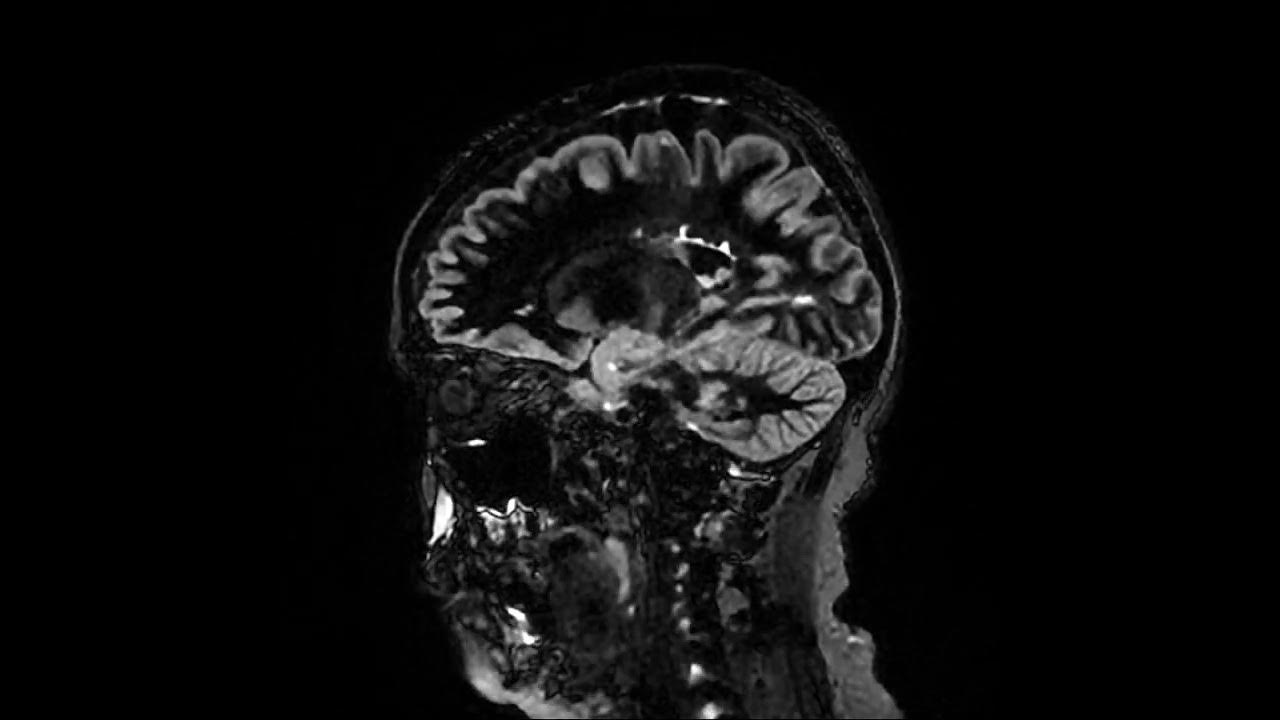 3D Sag T2 DIR Cube WM Null PROMO with AIR RECON DL - YouTube