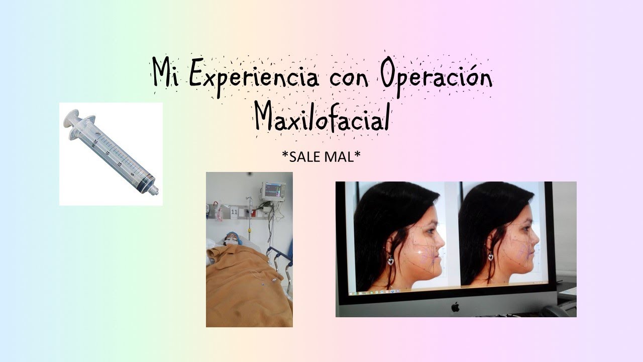 Mi Operación Maxilofacial - EXPERIENCIA CON LA CIRUGÍA / ESTEFANNY ...