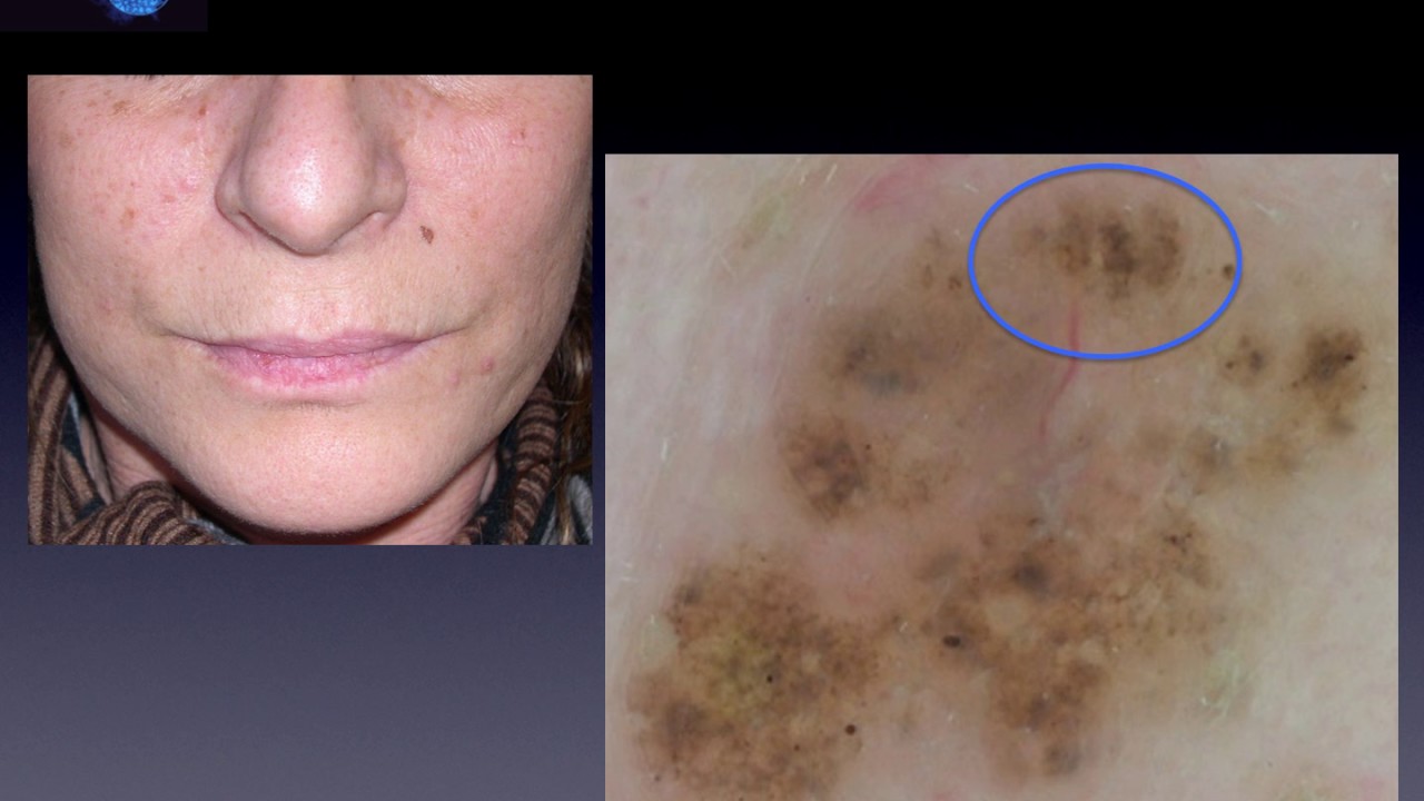 Carcinoma basocelular - Dra. Emilia Cohen-Sabban - YouTube