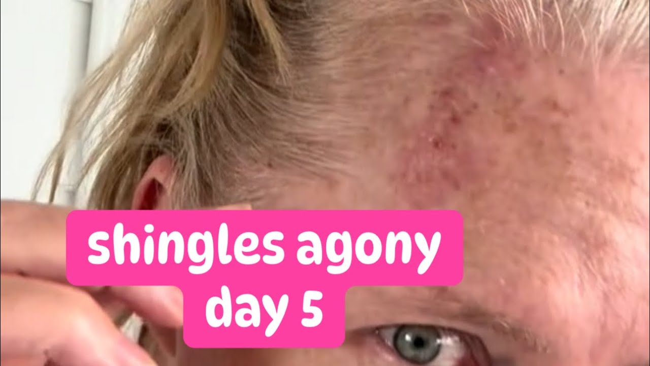 Shingles day 5 update - YouTube