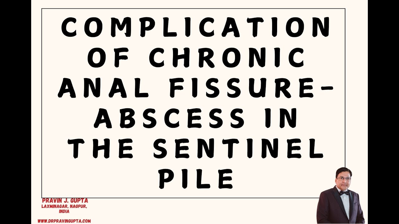 COMPLICATION OF CHRONIC ANAL FISSURE- ABSCESS IN THE SENTINEL PILE ...