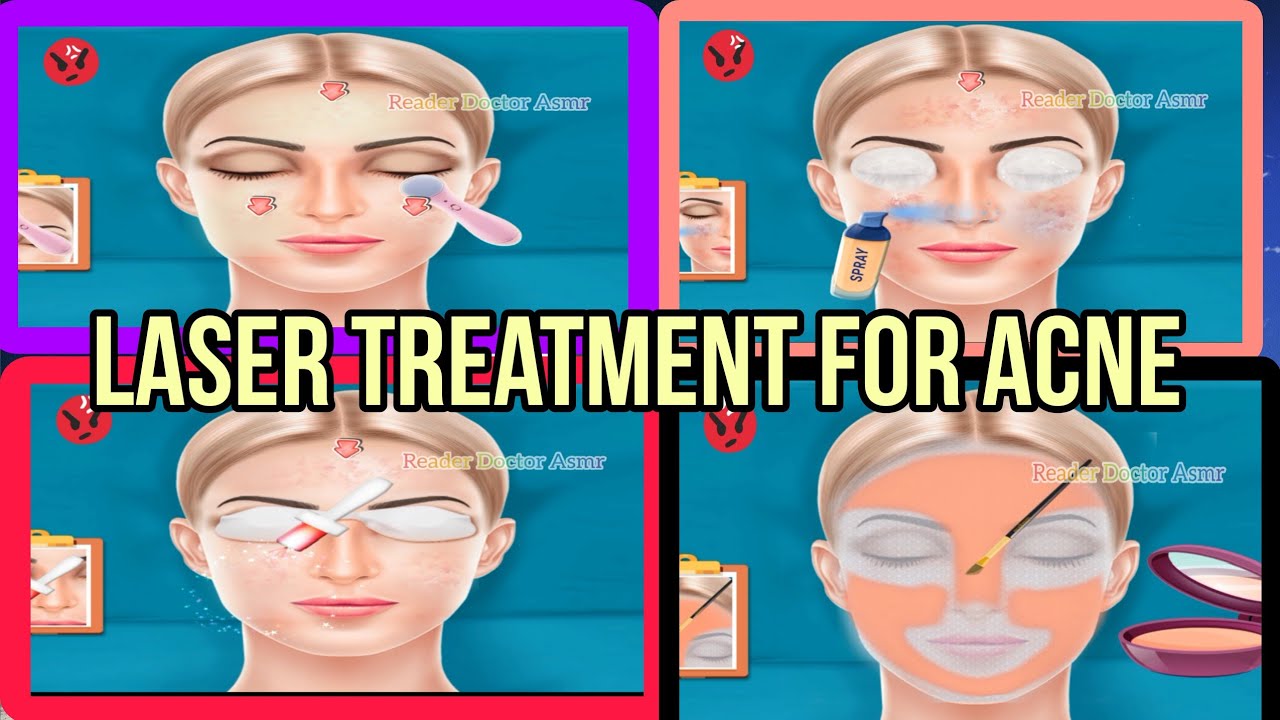 Acne Scar Lazer Asmr/Acne Scar Treatment animation/Remove Acne form ...