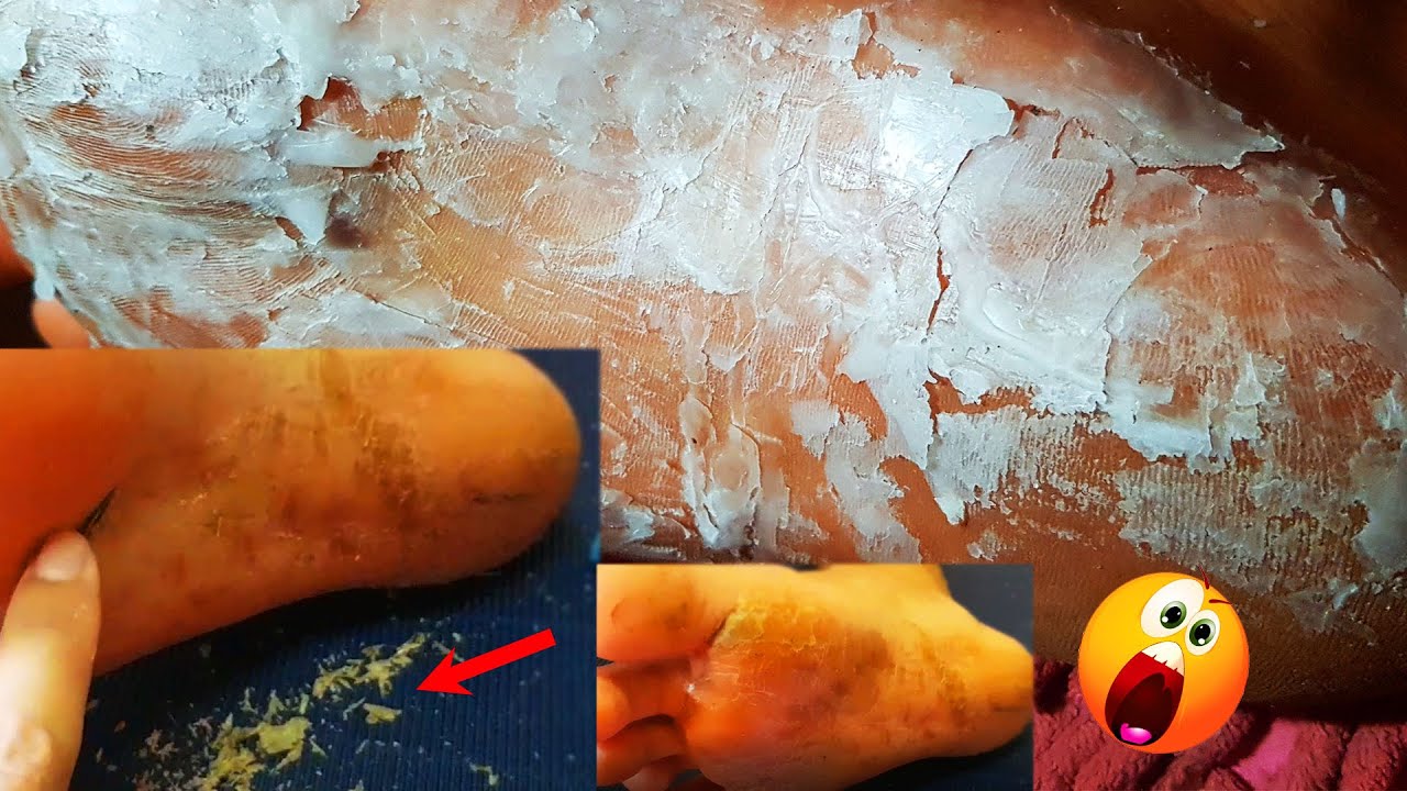 Incredible!! Removal Skin Flakes/Skin Care End(Big Flakes) #41 - YouTube