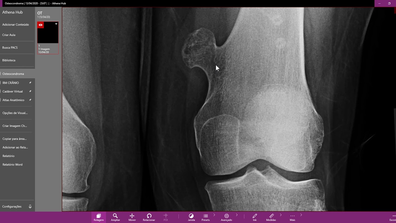 Osteocondroma - YouTube