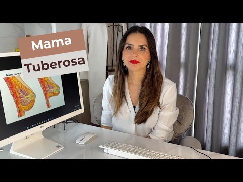 Mama Tuberosa o que é e como tratar mamas com tamanhos e formas diferentes | Cirurgiã Plástica