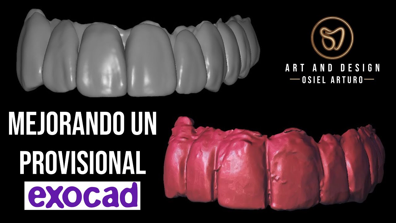 MEJORA DE UN PROVISIONAL EN PMMA/EXOCAD - YouTube