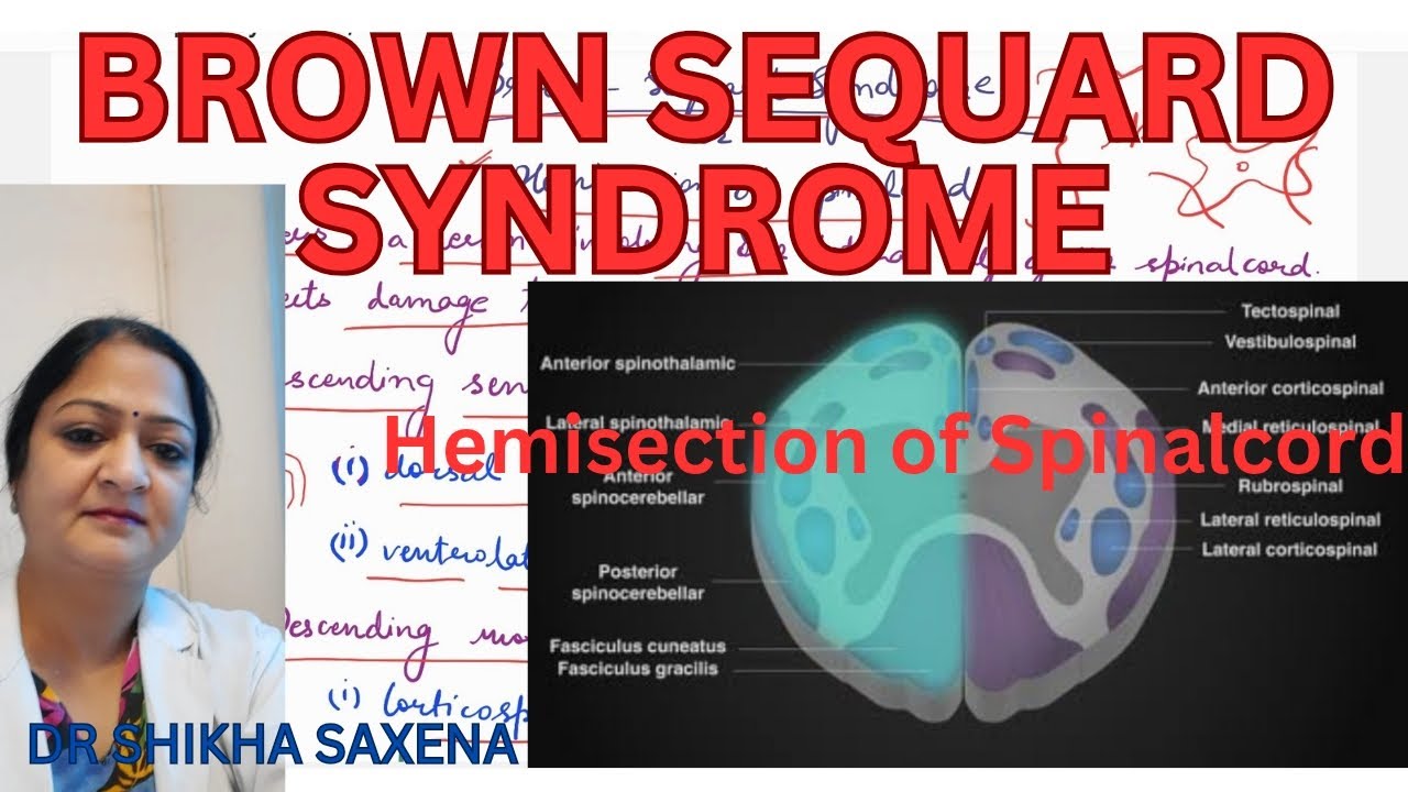Brown Sequard Syndrome, Hemisection of Spinal cord - YouTube