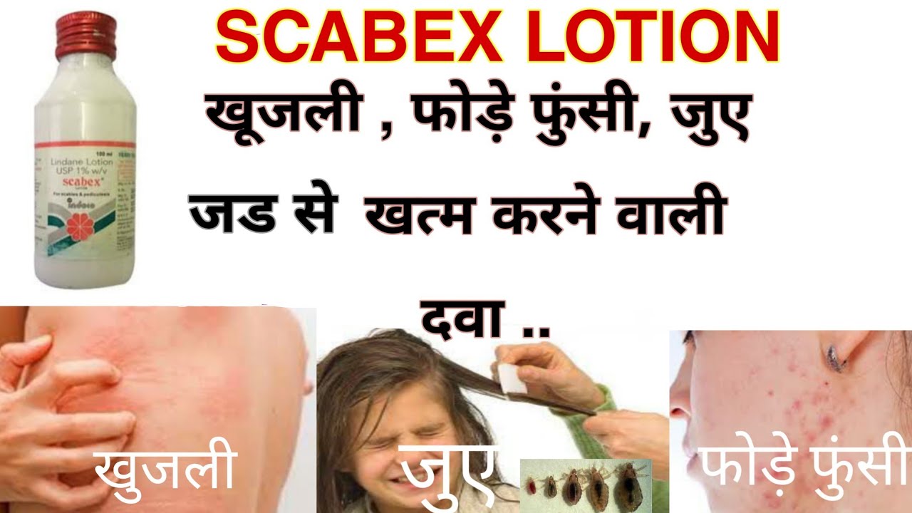 Scabex Lotion Full Information and Preview , शरीर में खुजली/फोडे फुंसी ...