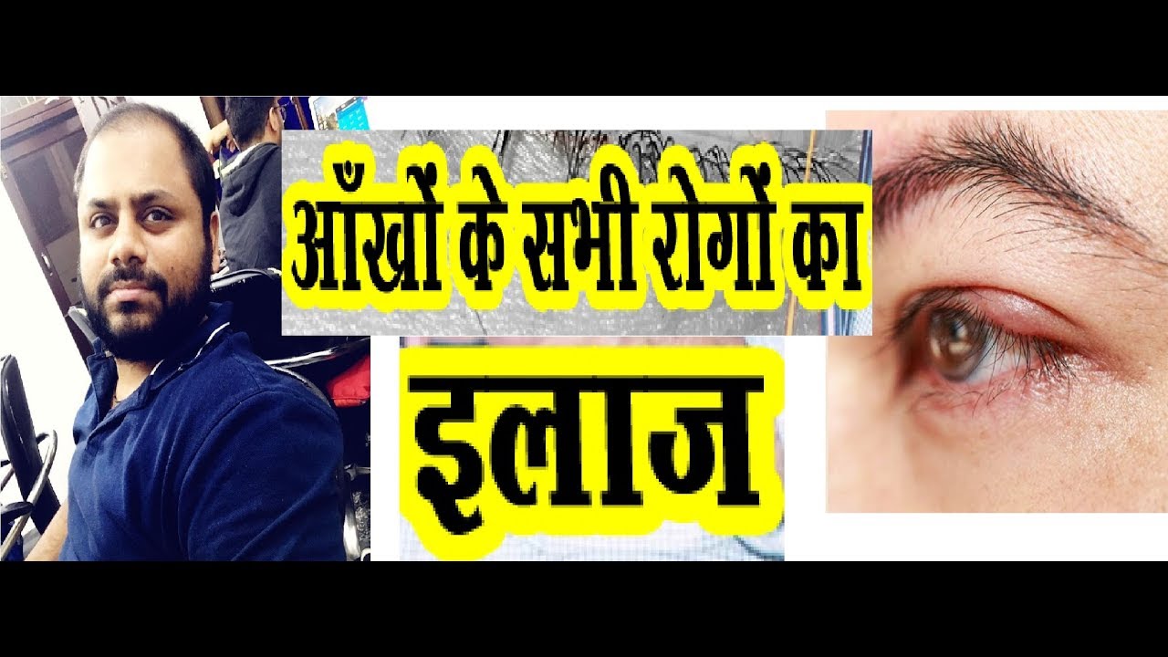 Eye problems treatment - Unani Treatment - YouTube