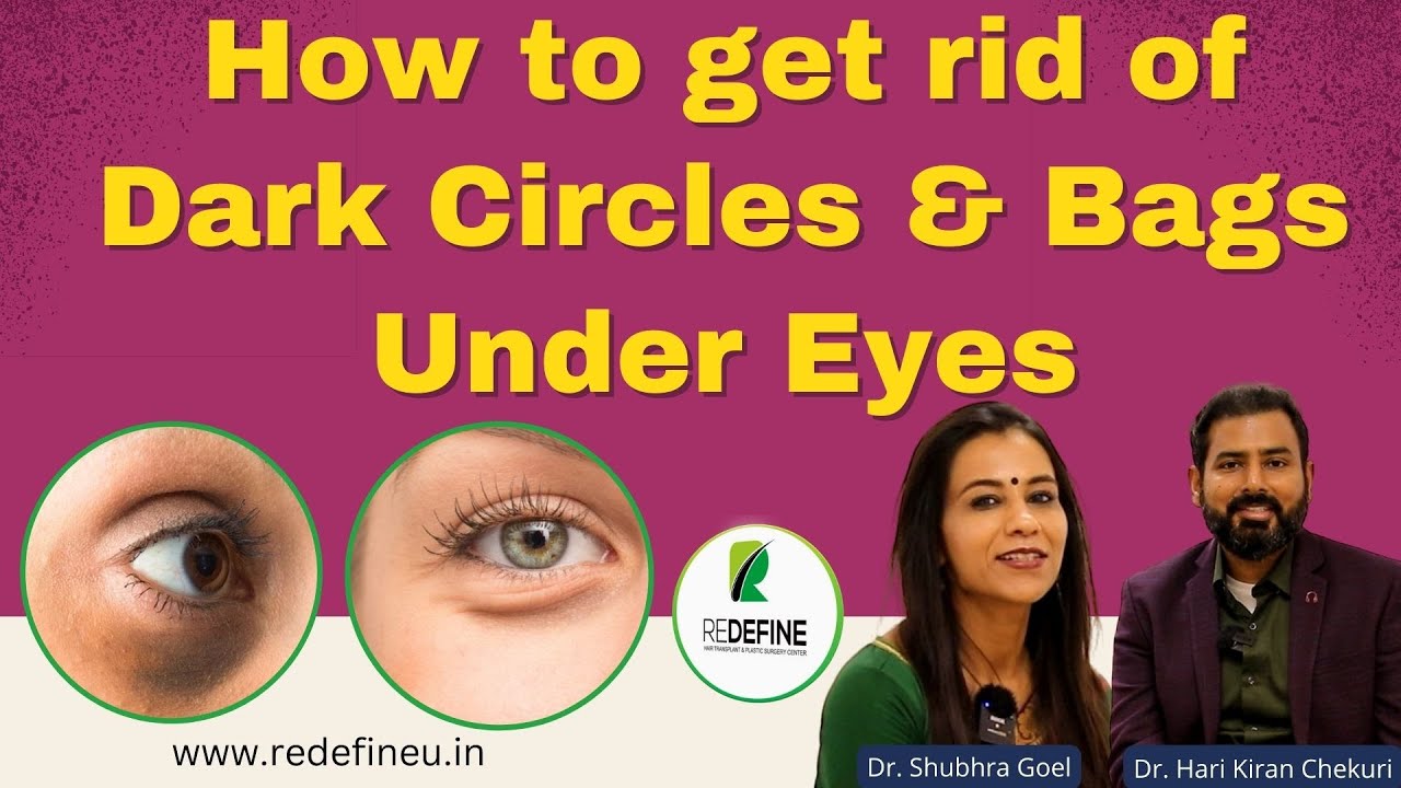 Best Treatment For Dark Circles & Under-Eye Bags || Redefine Plastic ...