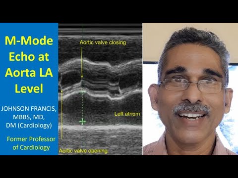 Your Aortic Root Measurement on Echo: What Numbers are Normal? - Answermind.blog