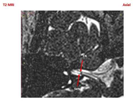 MRI Inner EAR Normal Findings T2 - YouTube