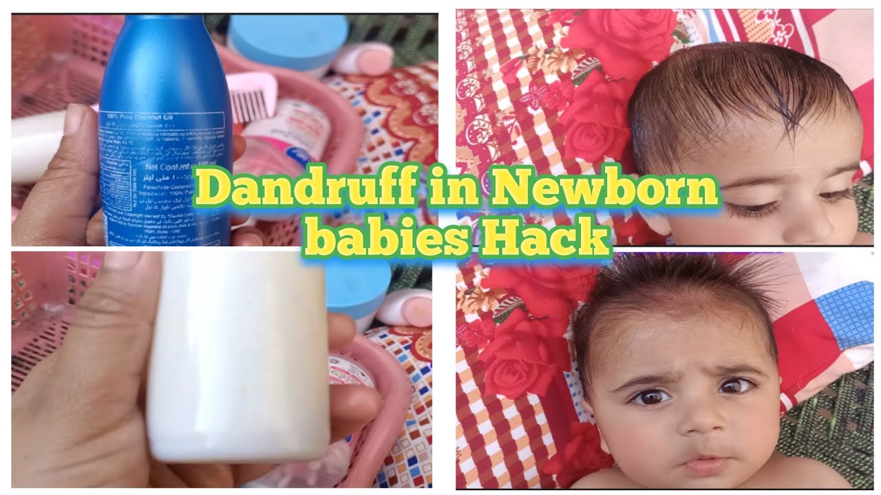 Dandruff in Newborn Babies| How to Deal with it at Home ...
