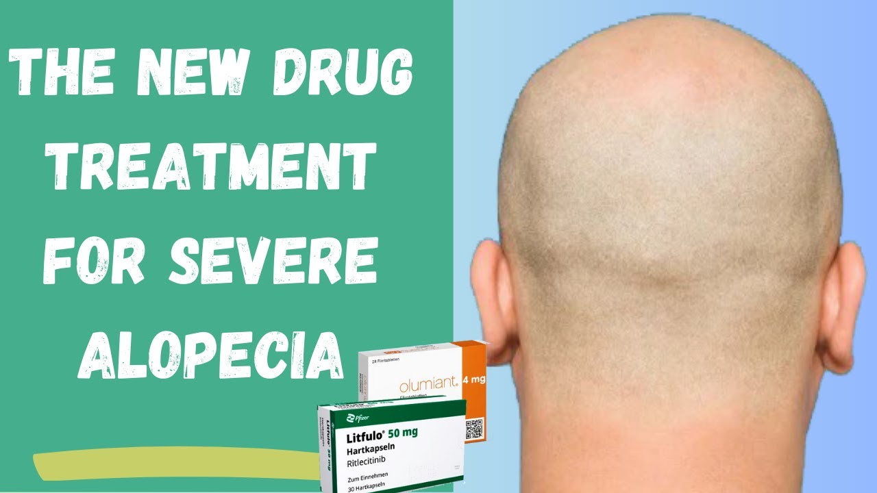 OLUMIANT & LITFULO, How Effective Are These Hair Loss Drugs For Hair ...