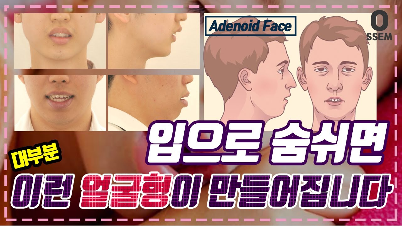 입으로 숨쉬면 얼굴형이 이렇게 변합니다 구호흡 비호흡 입술테이프 개방교합 아데노이드 얼굴형 입숨테이프 코숨