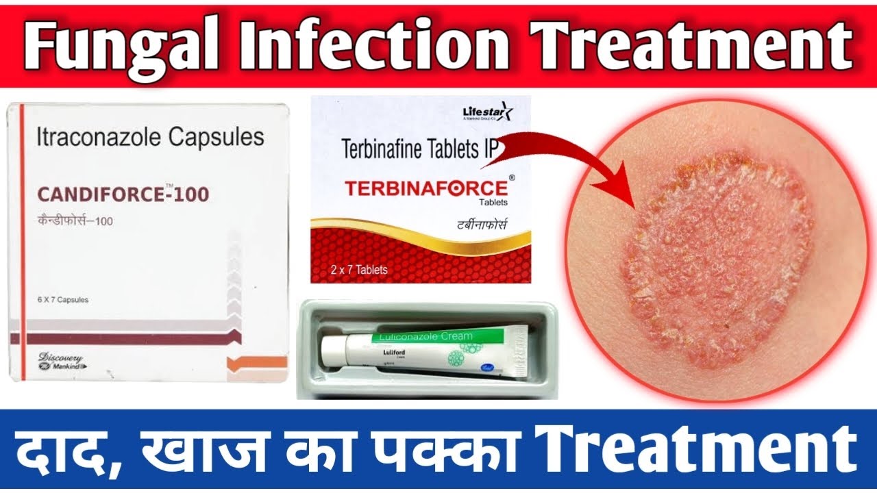 दाद खाज खुजली का पक्का इलाज|Fungal Infection Treatment|Unique Pharmacy ...
