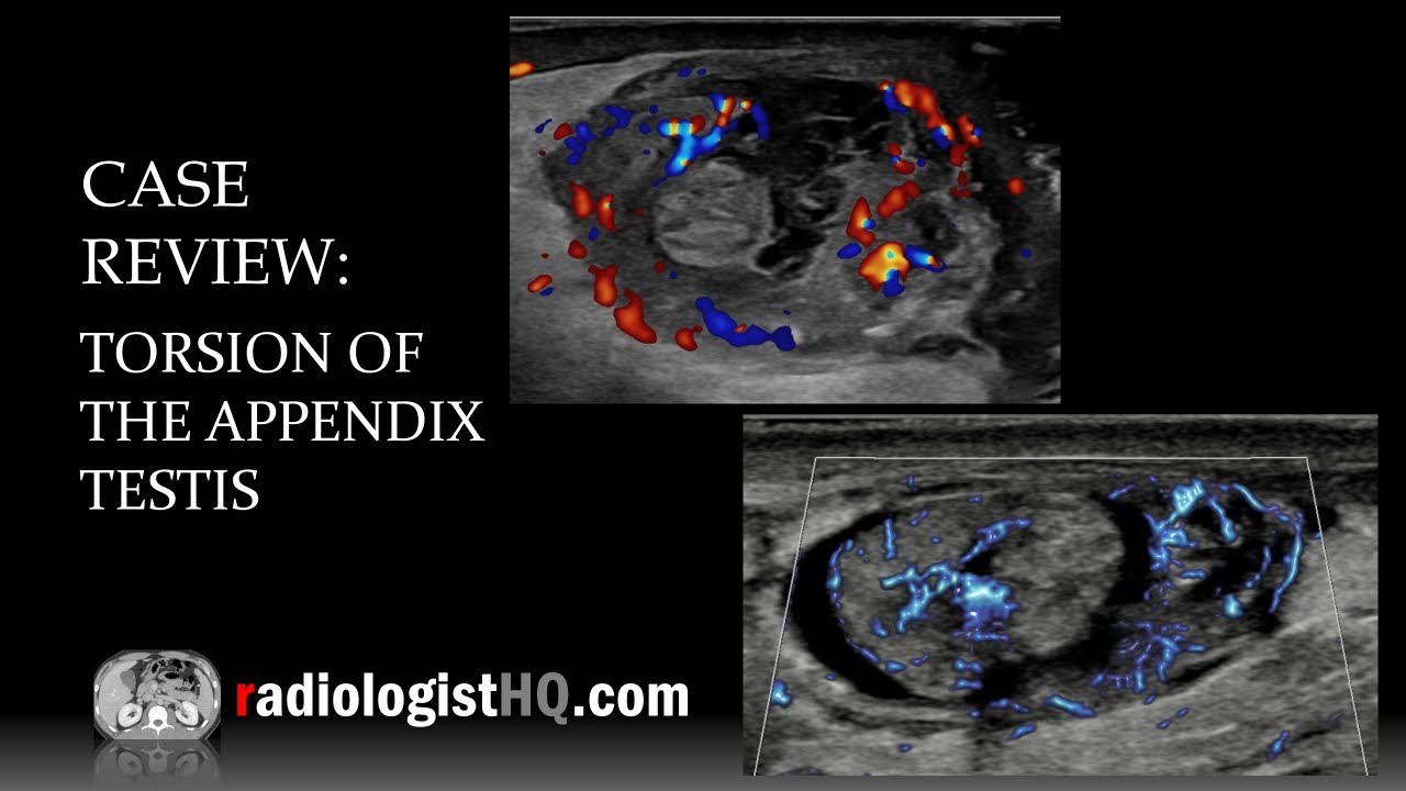 Ultrasound of Torsion of the Appendix Testis - YouTube