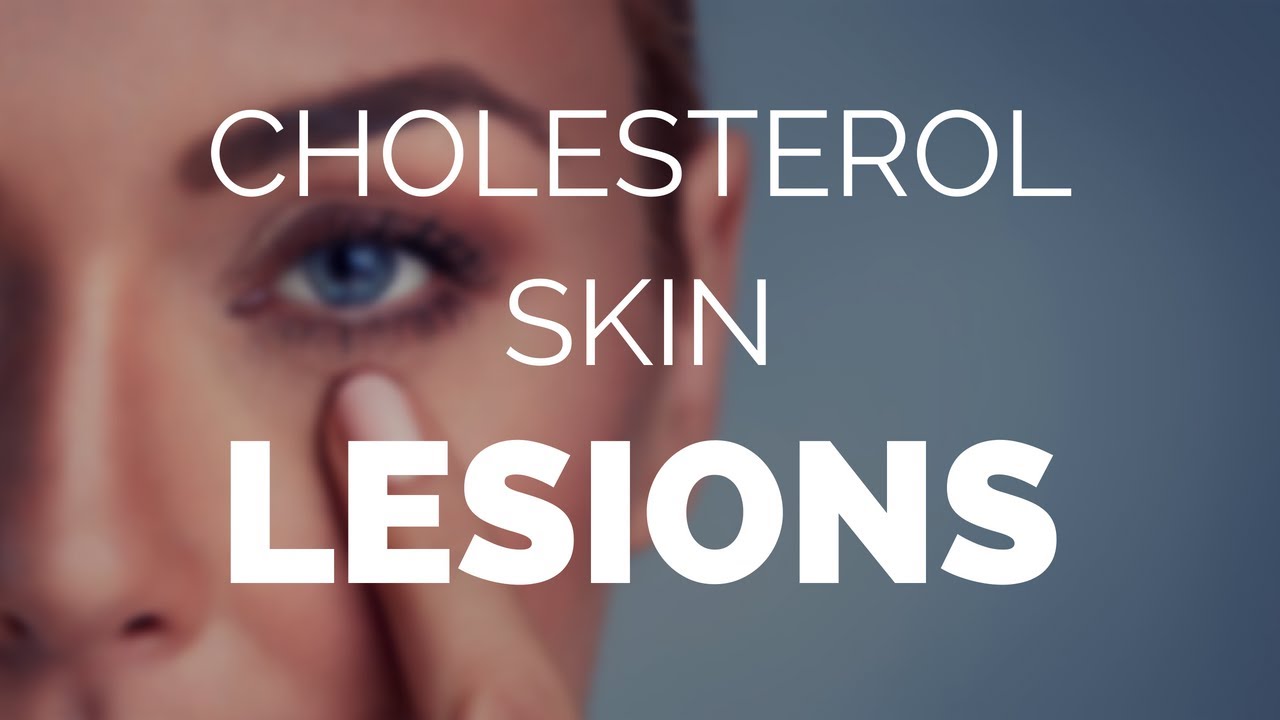 Cholesterol skin lesions and how to treat at home. - YouTube