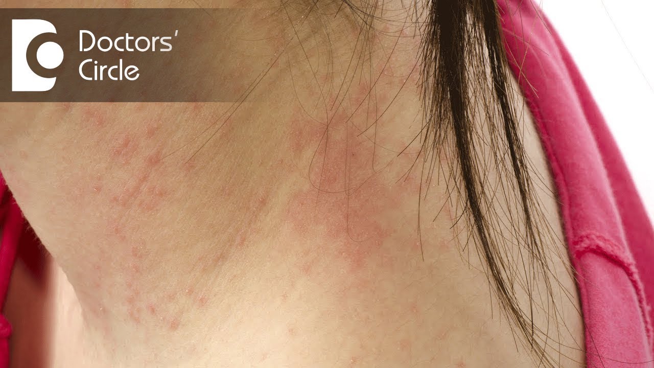 View 19 Rash On Back Of Neck At Hairline Trendqengineering