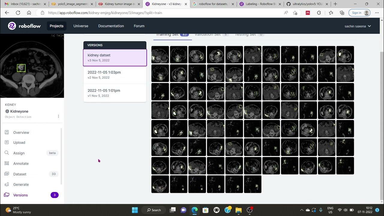 Kidney Tumor Segmentation using YOLOv5 in Pytorch | Stone Segmentation - YouTube