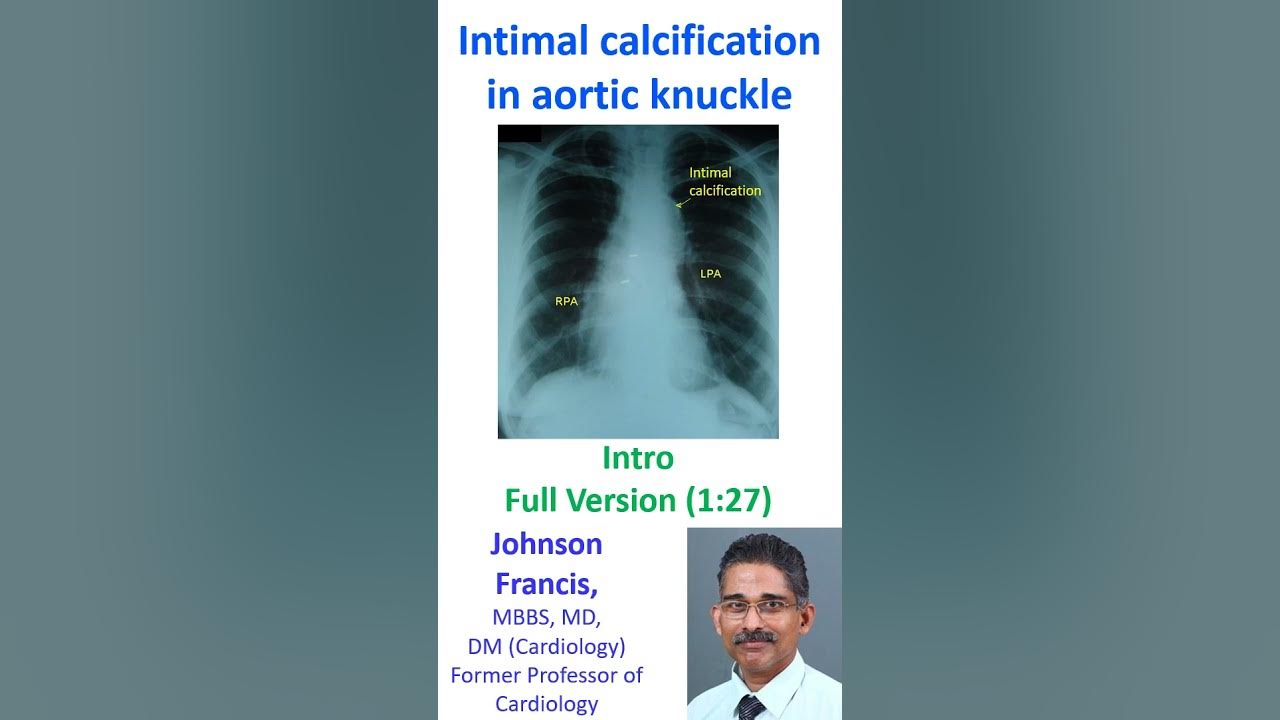 Intimal calcification in aortic knuckle X-ray chest PA - YouTube