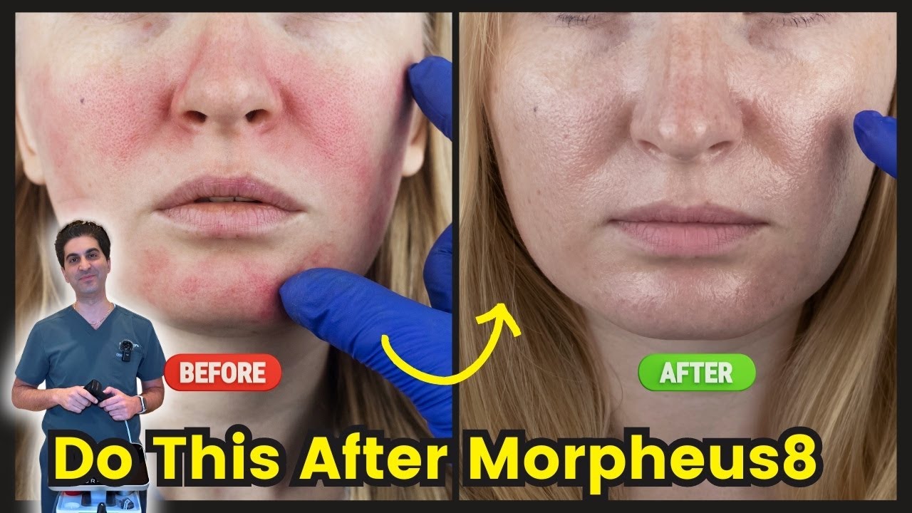 Morpheus8 Aftercare: What You NEED To Know - YouTube