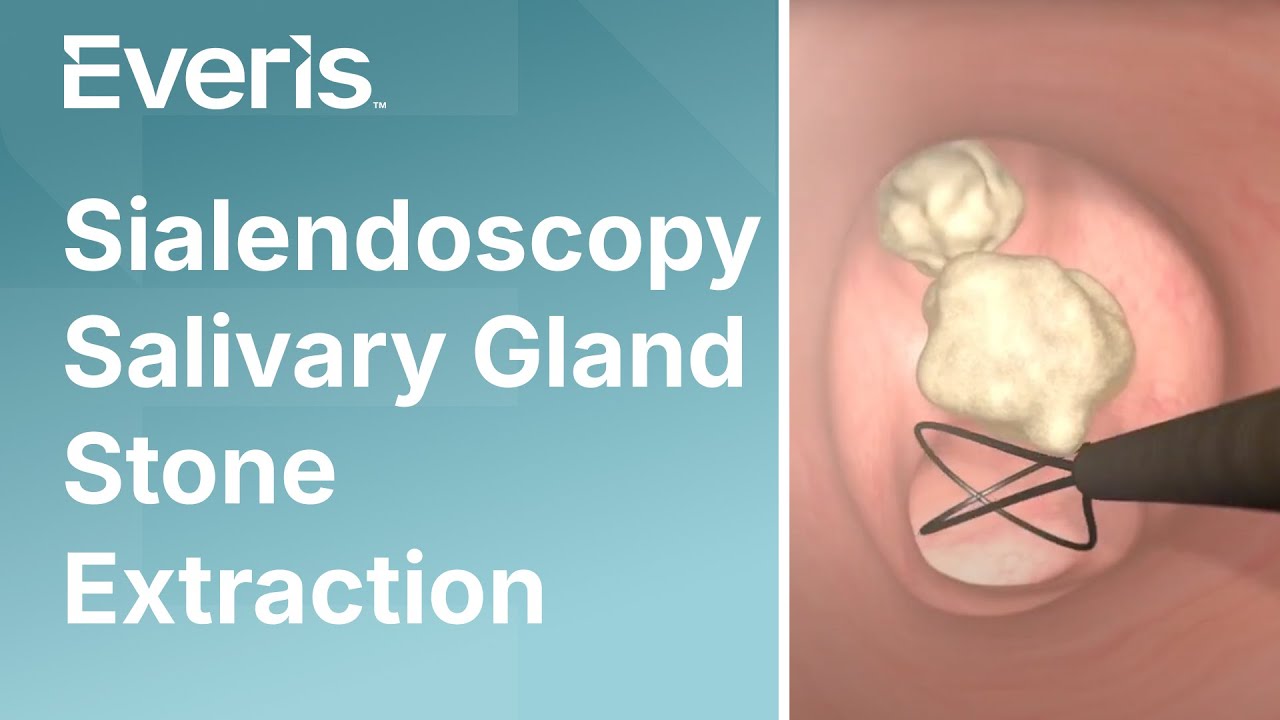 Sialendoscopy Salivary Gland Stone Extraction - YouTube