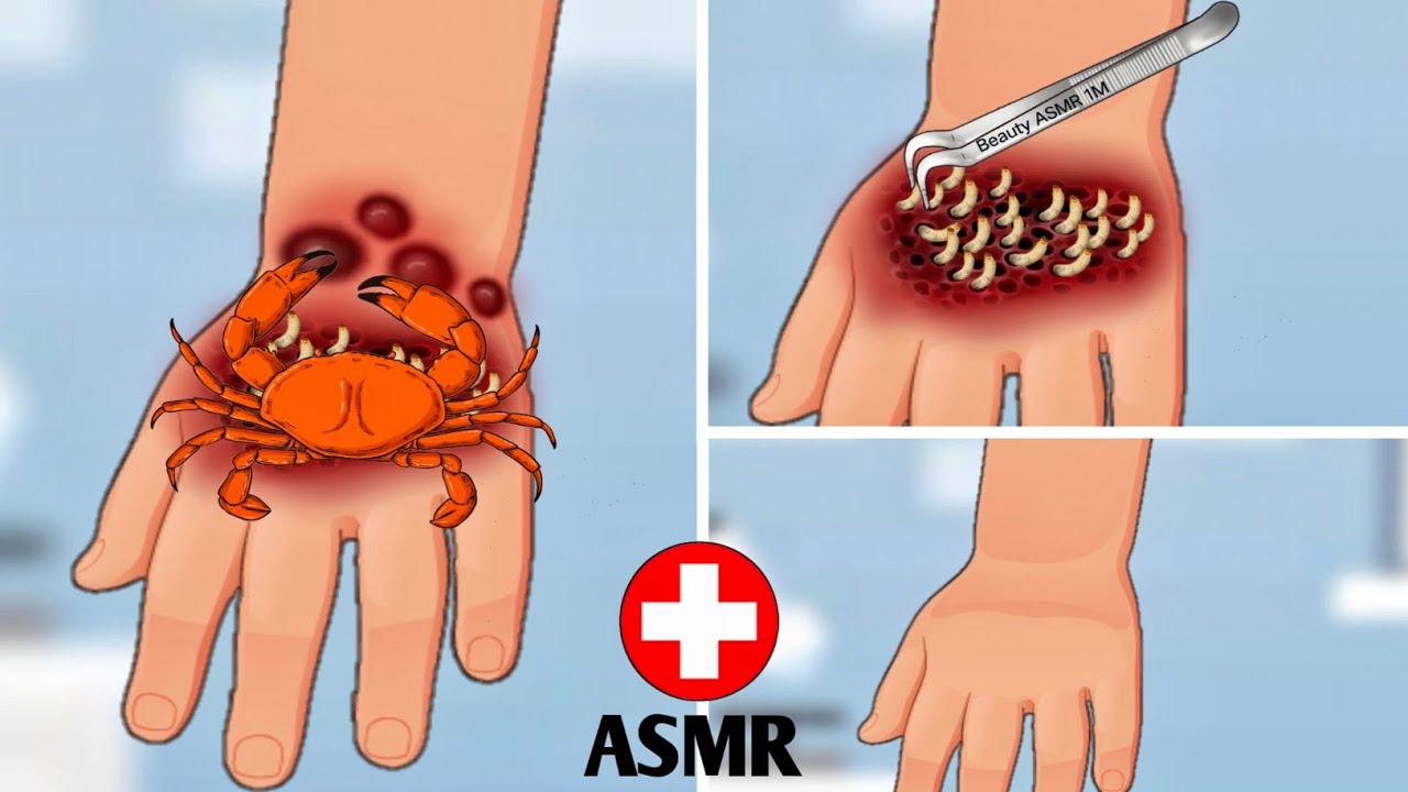 ASMR Maggot removal & Hand injured animation |2d animation ...