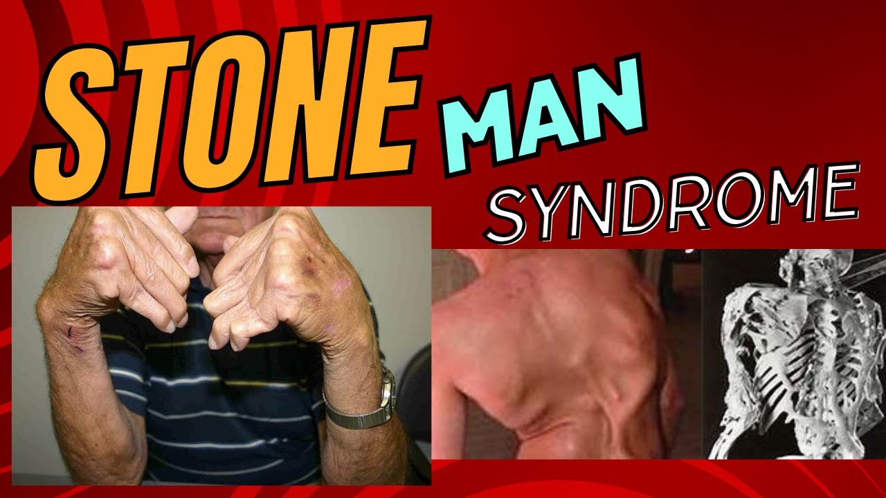 Stone man syndrome - YouTube