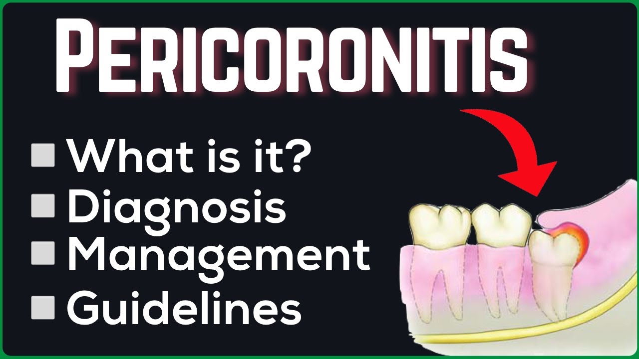 PERICORONITIS - Diagnosis & Management with guidelines - YouTube