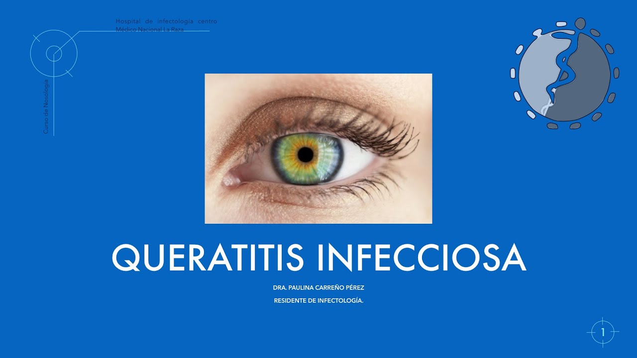 Queratitis infecciosa - YouTube