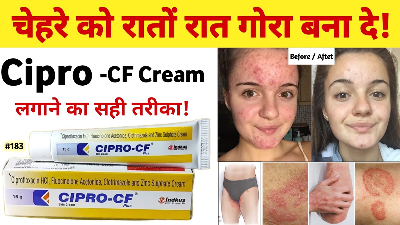 Cipro CF cream uses in hindi | ciprofloxacin, fluocinolone acetonide ...