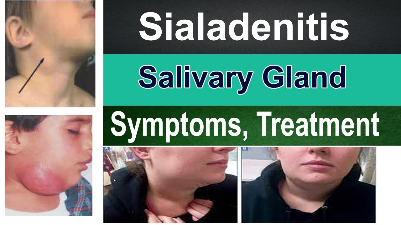 Sialadenitis - Sialadenitis lecture -Causes, Clinical features ...
