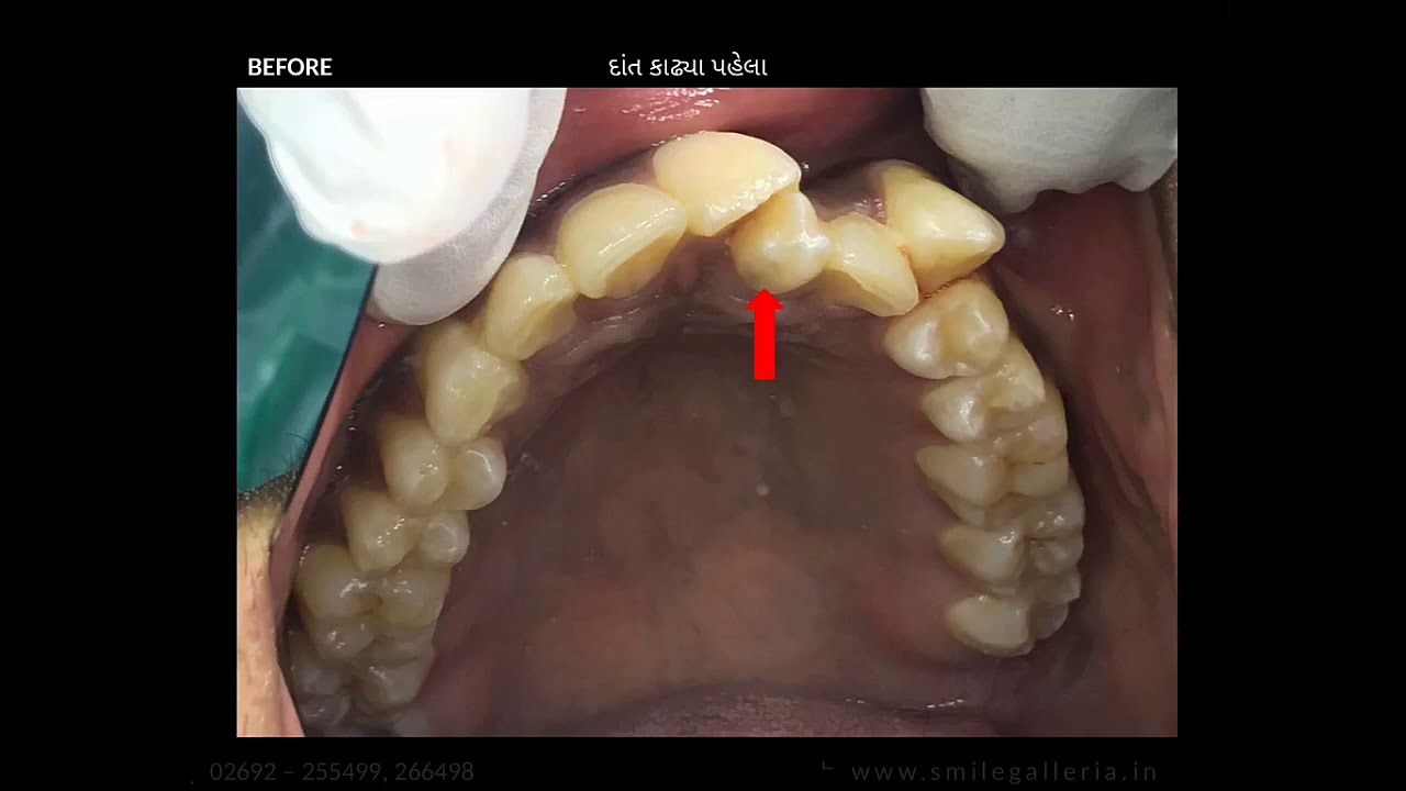 Supernumerary Tooth Extraction | Dental Surgeon | Anand | Gujarat - YouTube