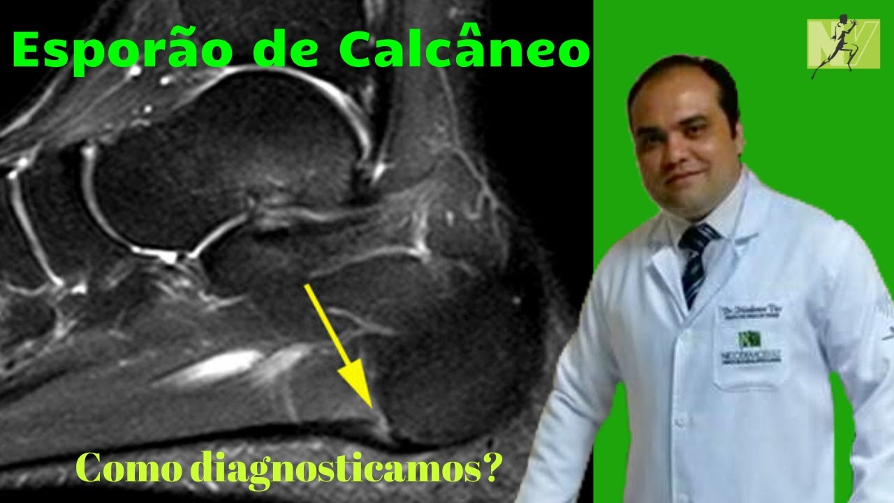 Esporão de Calcâneo. Como diagnosticamos? - YouTube