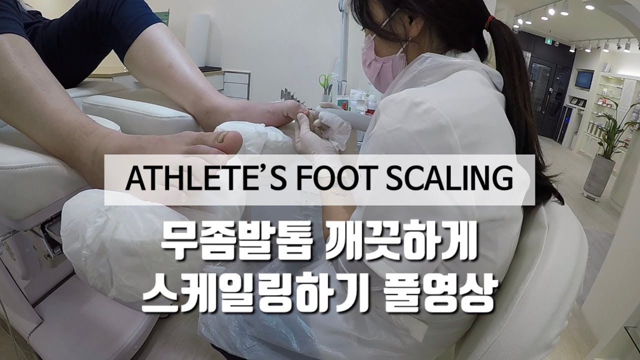 무좀발톱 속 시원하게 스케일링하기 풀영상 (설명 有) / 내성발톱 / FOOT SCALING / athlete's foot ...