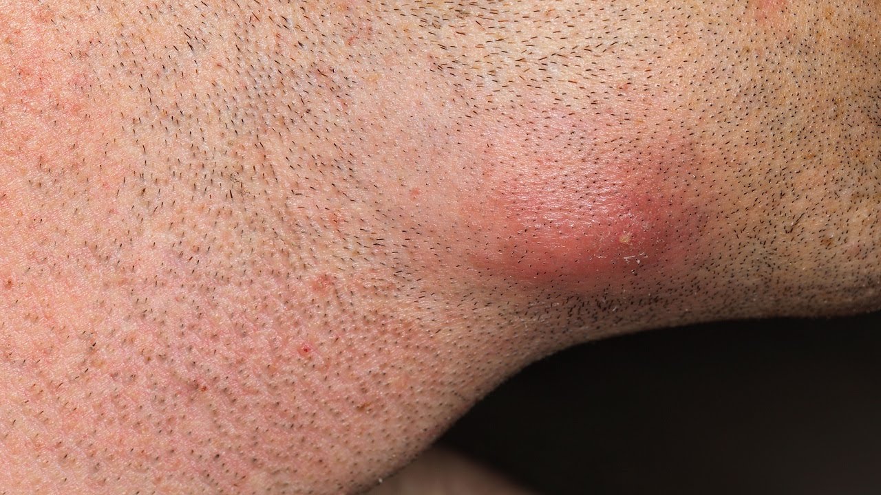 how to get rid of a boil with no head at home - YouTube