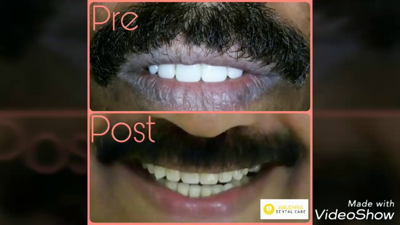 Implant Malo Bridge - Procedure by Dr. Shankar Guhan at Arudhra Dental ...