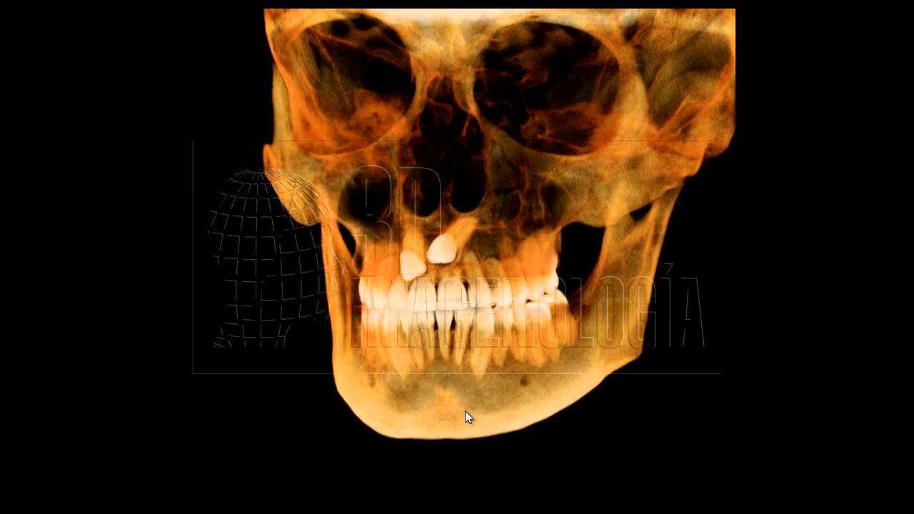 RX PANORAMICA VS TOMOGRAFIA CONE BEAM - YouTube