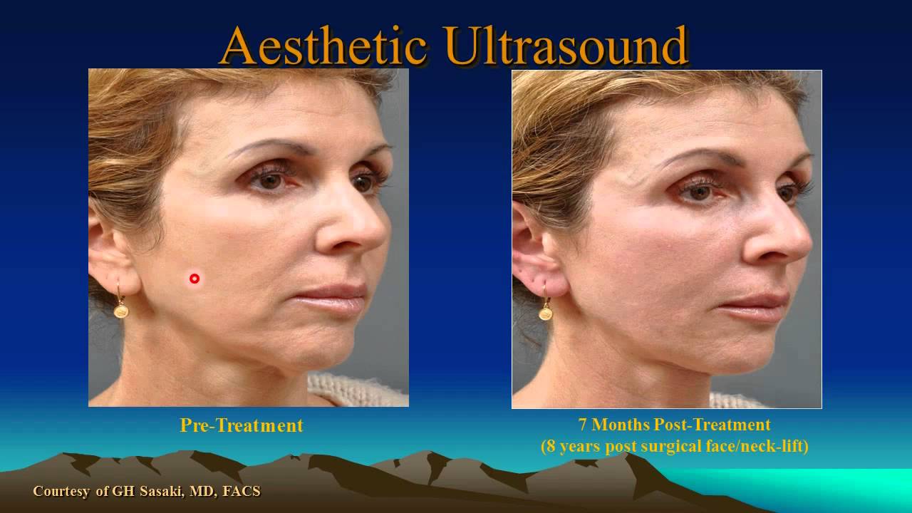 Ulthera, Ultherapy-- Part 2 - YouTube