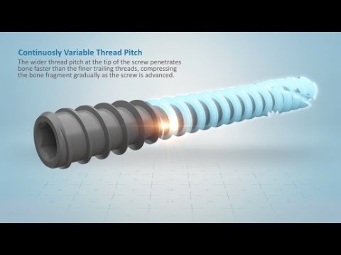Acutrak 2 Headless Compression Screw System Overview - YouTube