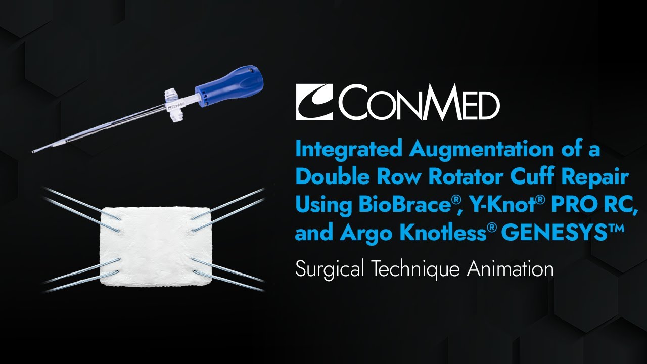 Augmentation of Double Row RCR using BioBrace®, Y-Knot® PRO RC, and ...