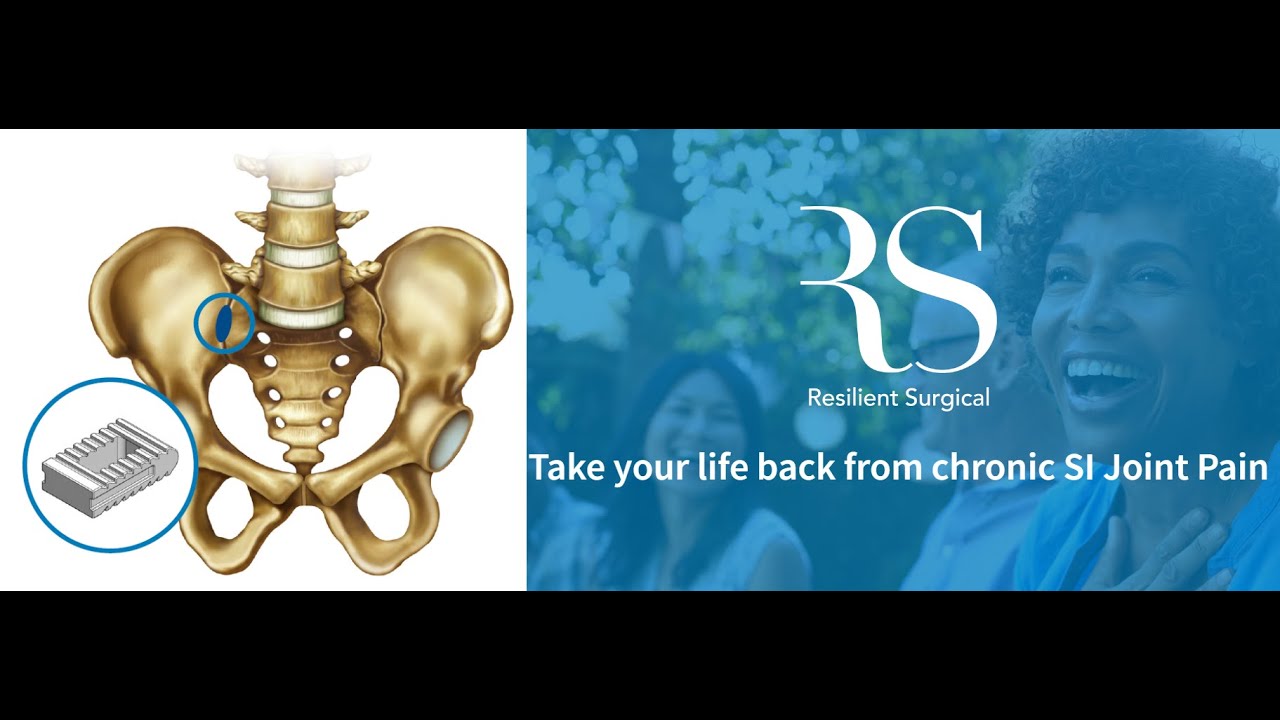 Resilient Surgical:Unio Sacroiliac (SI) Joint Fusion - YouTube