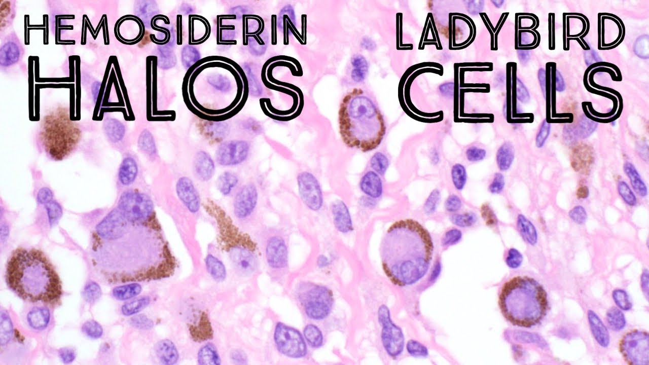 Hemosiderin Halos / Ladybird Cells in Giant Cell Tumor of Tendon Sheath ...
