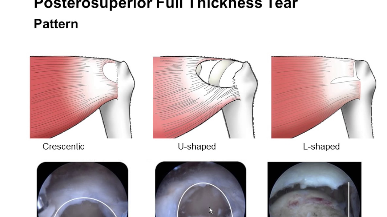 Shoulder Rotator Cuff Tear ISAKOS 서경진 - YouTube